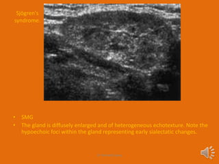 Dr Ahmed Esawy Salivary gland ultrasound | PDF