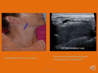 Submandibular Gland Ultrasound