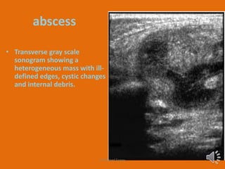 Submandibular Abscess Ultrasound