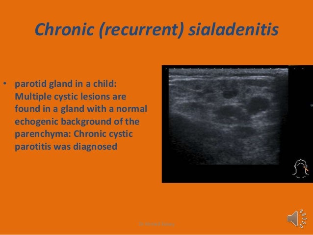 Dr Ahmed Esawy Salivary gland ultrasound