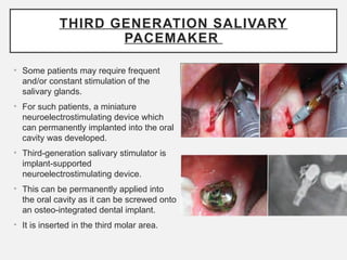Salivary_Pacemaker_Presentation_stimulation of saliva.pptx