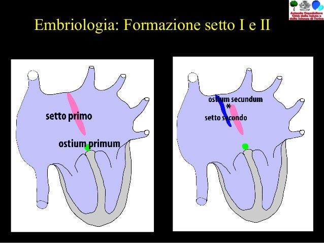 Il difetto interatriale