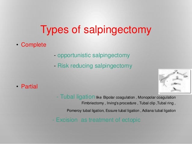 Salpingectomy for ovarian risk reduction