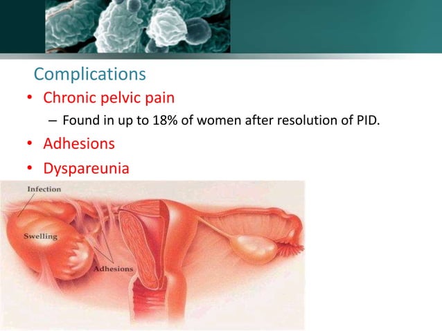 Salpingitis Pptx Infertility Reproductive Health