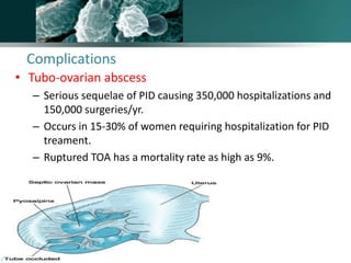 Salpingitis | PPTX