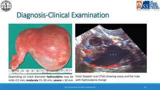 Salpingitis Hydrosalpinx | PDF