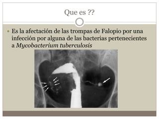 Salpingitis tuberculosa | PPTX