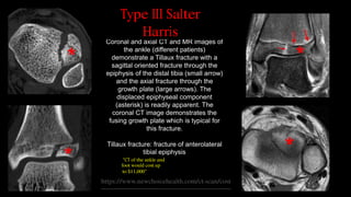 Salter-Harris-II-Tibial-Fracture-Kyra-Frost-MS4-Dr.M.-Kumaravel-Copy-1.pdf