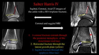 Salter-Harris-II-Tibial-Fracture-Kyra-Frost-MS4-Dr.M.-Kumaravel-Copy-1.pdf