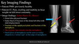 Salter Harris Ii Tibial Fracture Kyra Frost Ms4 Dr M Kumaravel Copy 1 Pdf