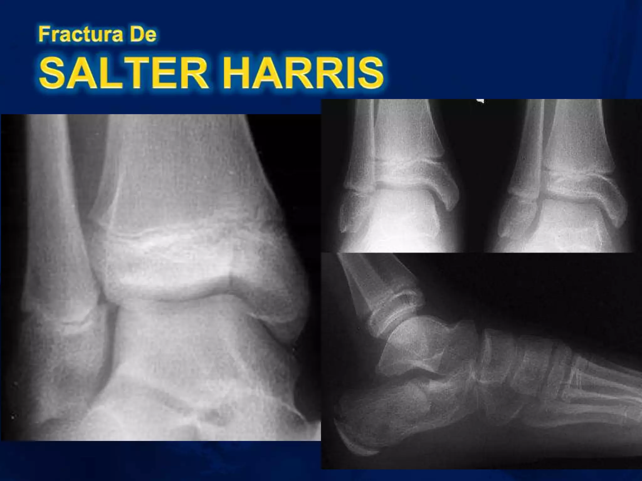 Fractura Salter harris | PPTX
