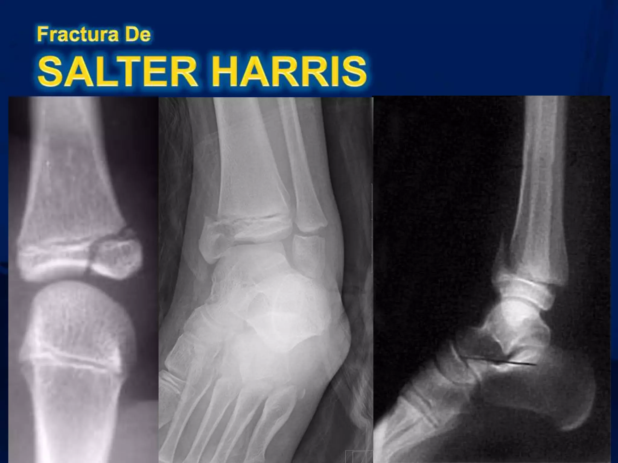 Fractura Salter harris | PPT
