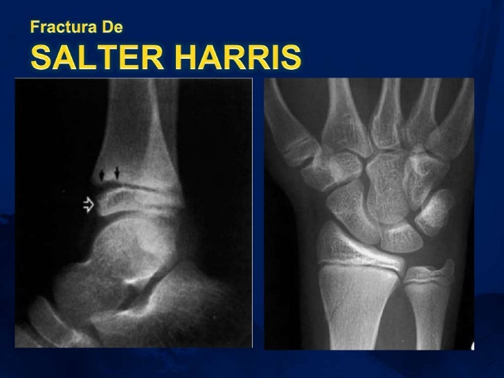 Fractura Salter harris