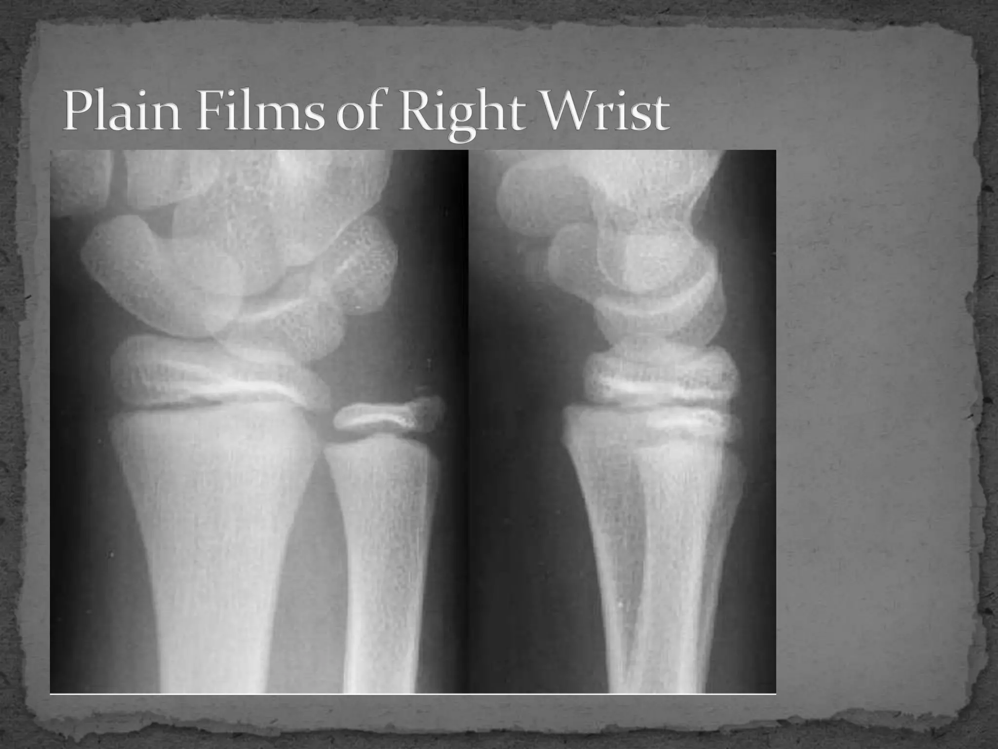 Salter harris 1 Power Point | PPT