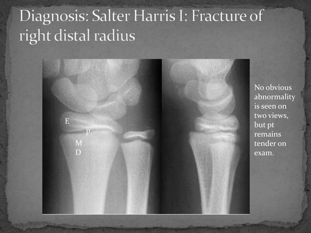 Salter harris 1 Power Point | PPT