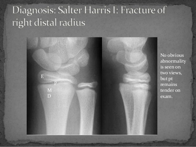 Salter harris 1 Power Point