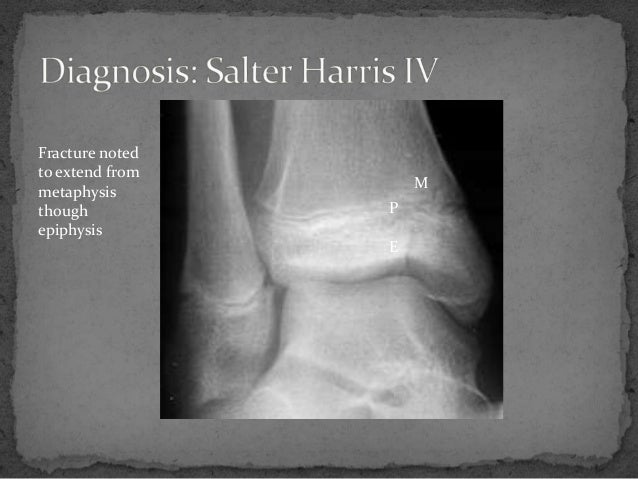 Salter harris 4 Power Point