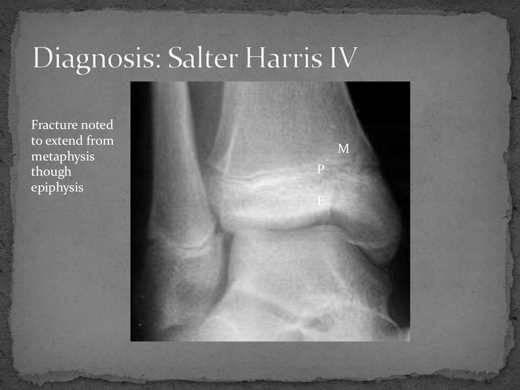 Salter harris 4 Power Point