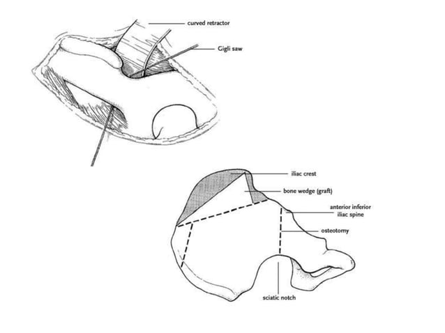 Salter osteotomy workshop | PPTX | Death, Injury, or Military Conflict ...