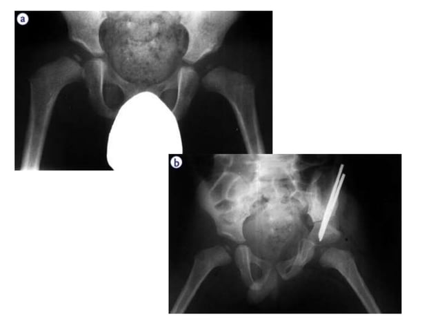 Salter osteotomy workshop | PPTX | Death, Injury, or Military Conflict ...