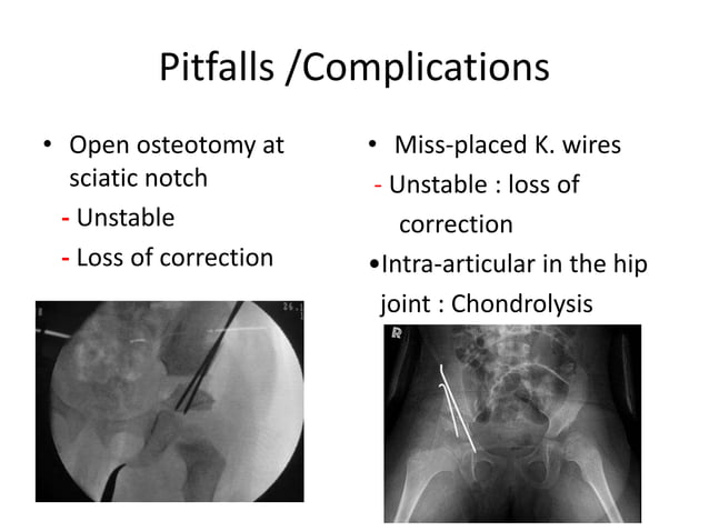 Salter osteotomy workshop | PPTX | Death, Injury, or Military Conflict ...