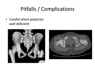 Salter osteotomy workshop | PPTX | Death, Injury, or Military Conflict ...