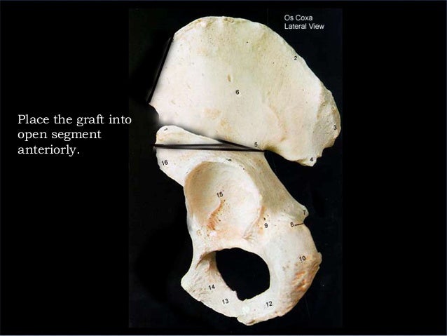 Salter's innominate osteotomy