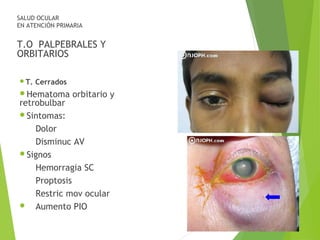 Salud ocular | PPT
