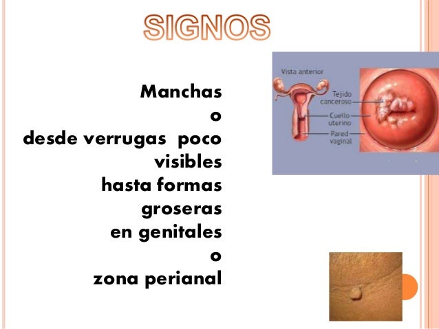 TP - Condilomas jennifer y victoria