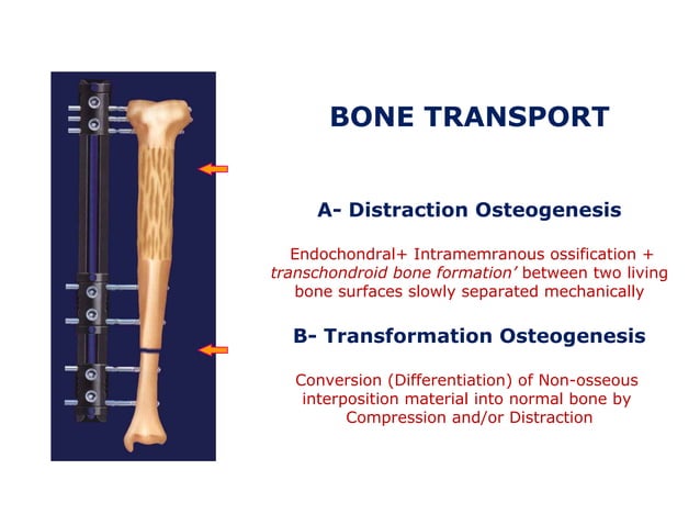Salvage of bone defects | PPT