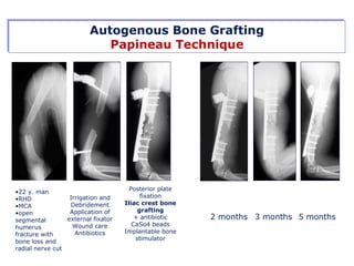 Salvage of bone defects | PPT
