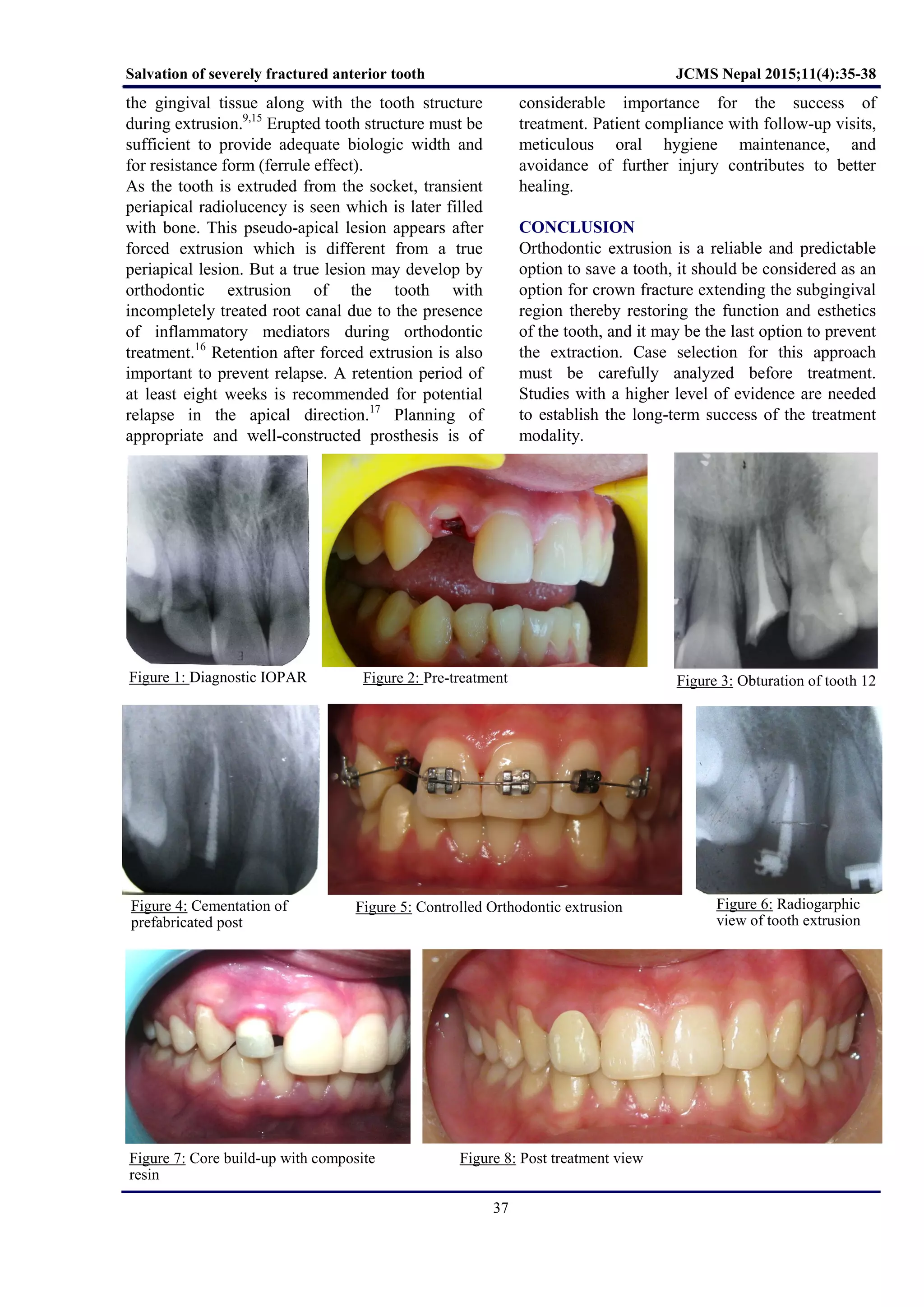 Salvation of severely fractured anterior tooth: An orthodontic approach ...
