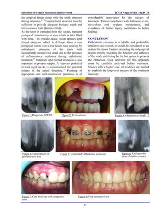 Salvation of severely fractured anterior tooth: An orthodontic approach ...