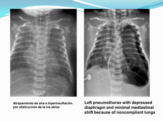 Sindrome de aspiracion meconial | PPTX