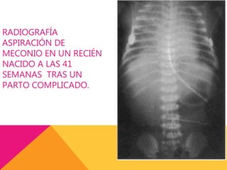 Síndrome de aspiración de meconio | PPTX