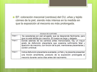 Sindrome de aspiración meconial - SAM | PPTX