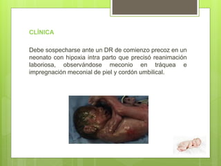 Sindrome de aspiración meconial - SAM | PPTX