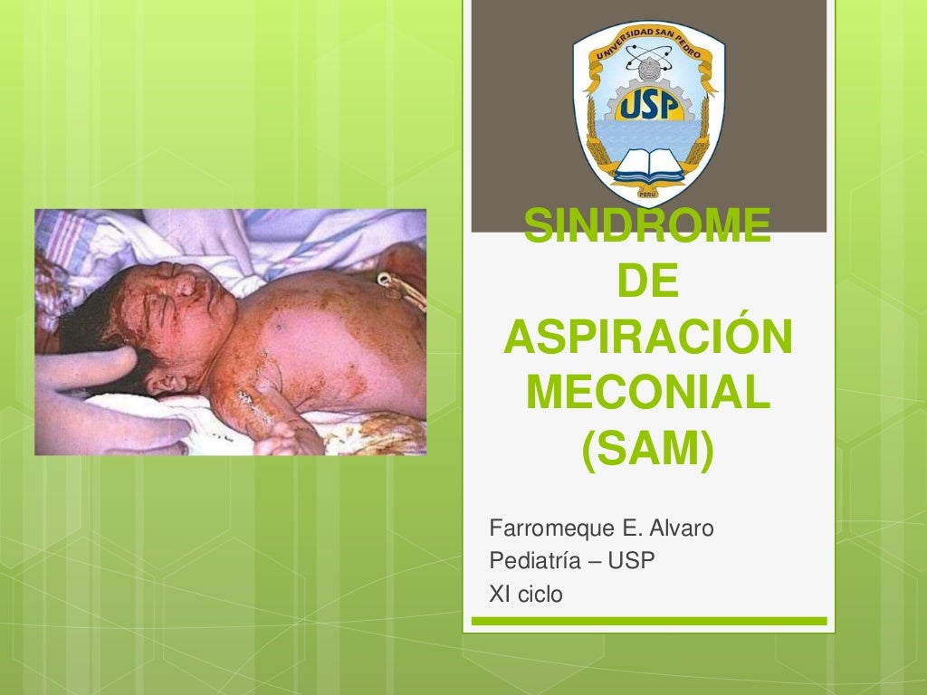 Sindrome De Aspiracion Meconial - vrogue.co Sindrome De Aspiracion Meconial - vrogue.co