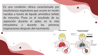 Sindrome de aspiracion meconial | PPTX