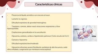 Sindrome de aspiracion meconial | PPTX