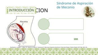 Sindrome de Aspiracion de Meconio en Neonatologia.pptx