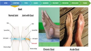 Gout - 7 Minute Presentation | PPT