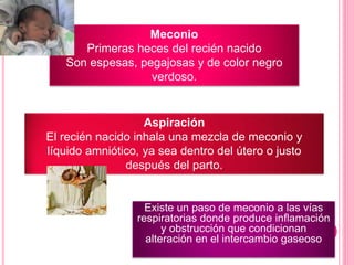 sindrome de aspiracion de meconio expoppt | PPT