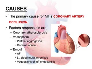 MYOCARDIAL INFARCTION-MANAGEMENT | PPTX