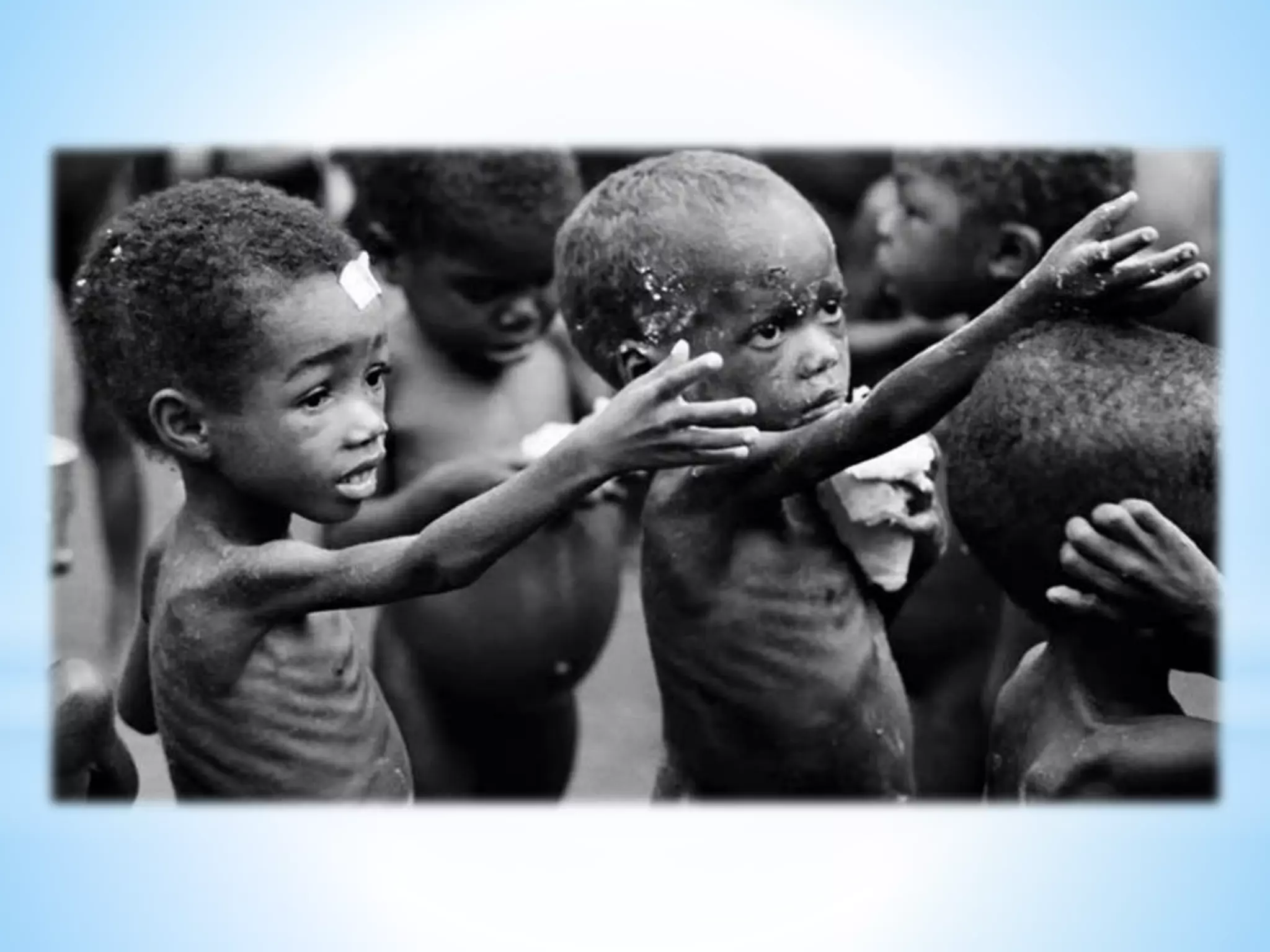 Severe Acute Malnutrition | PPTX