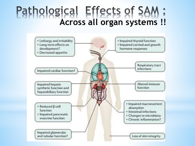 Severe Acute Malnutrition