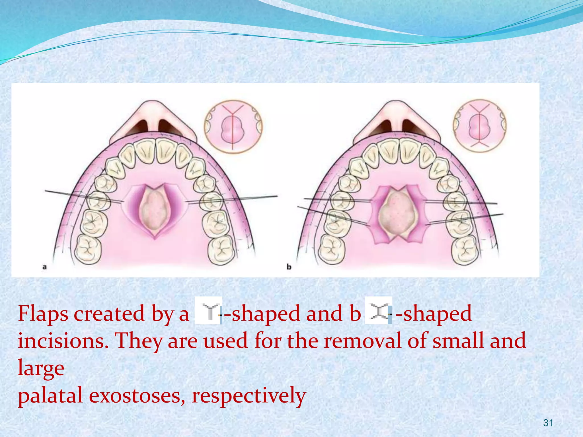 surgical flaps oral surgery | PPTX