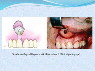 surgical flaps oral surgery | PPTX