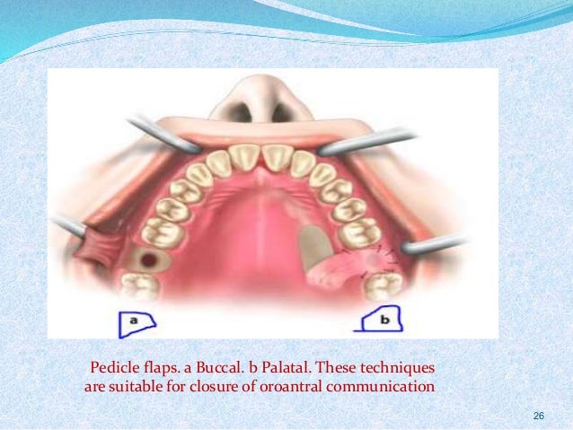 surgical flaps oral surgery