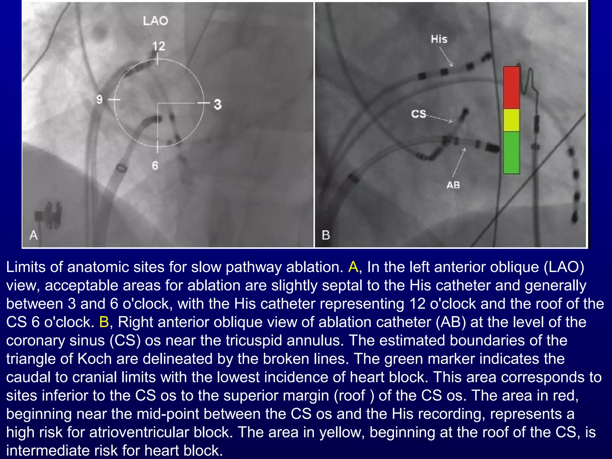 Samir Rafla technique of ablation of AVNRT and case presentation | PPT